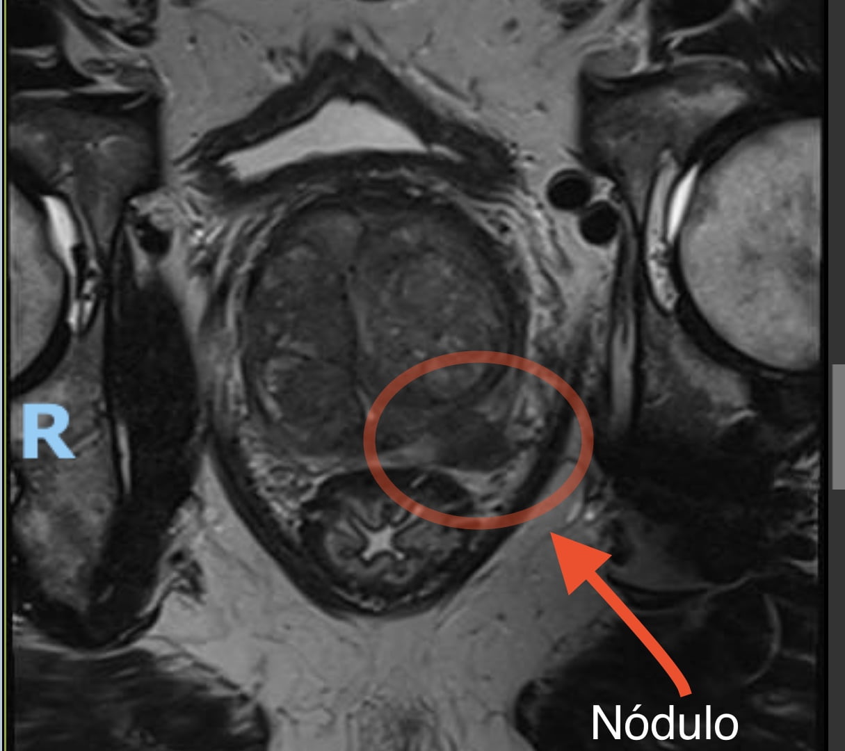 Câncer de Próstata: Detecção Precoce e Métodos de Diagnóstico